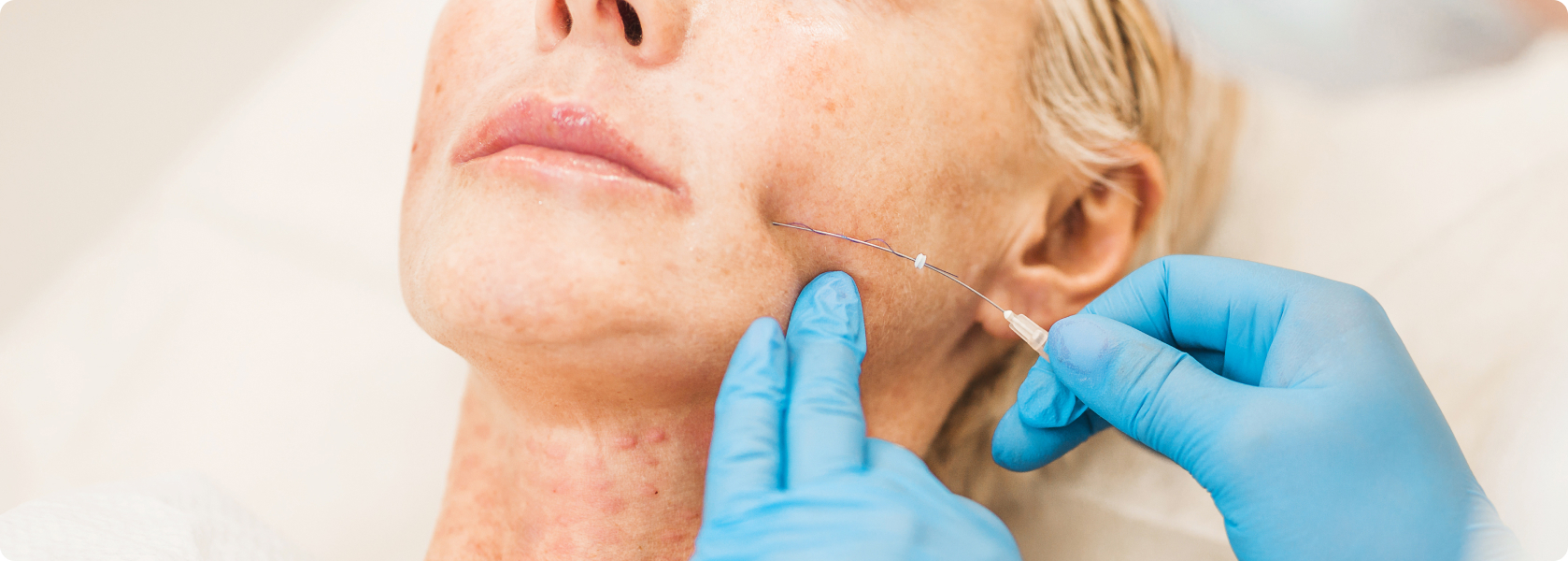 Fadenlifting Behandlung | Ärzte- und Laserzentrum Frankfurt